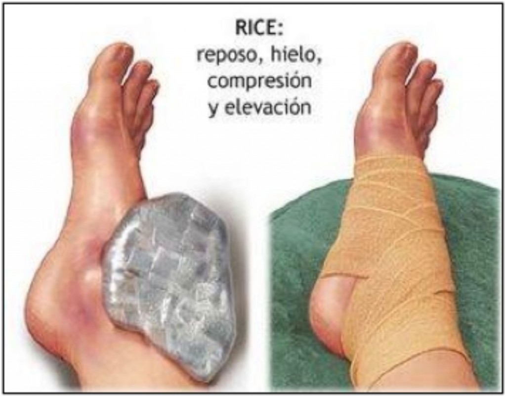 Esguince de tobillo. Todo lo que hay que saber | Entretantomagazine